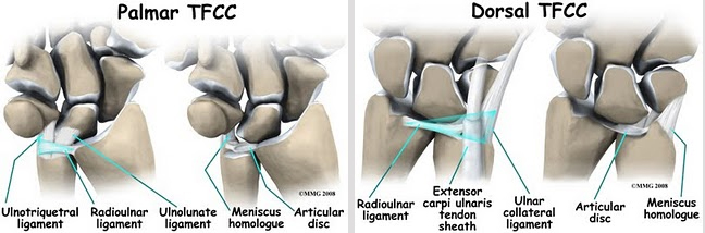 Triangular fibrocartilage complex lesions, TFCC(삼각 섬유연골 복합체 병변) : 네이버 블로그