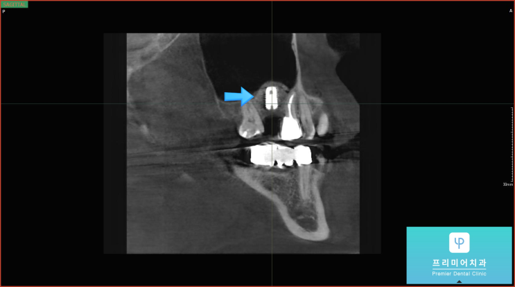 상악동 거상술 뼈이식 임플란트, 측방 접근법(Lateral Window Approach)에 관하여 : 네이버 블로그