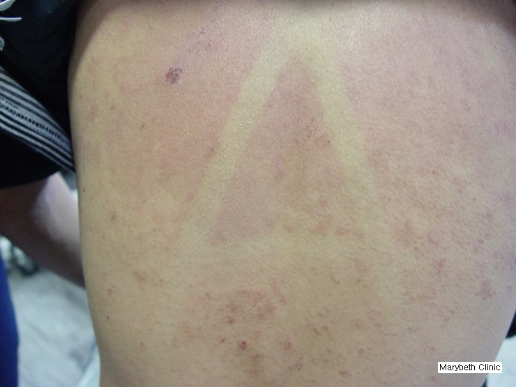 백색 피부묘기증(백색피부그림증, White dermographism) - 청주 메어리벳의원 정종영 원장 : 네이버 블로그