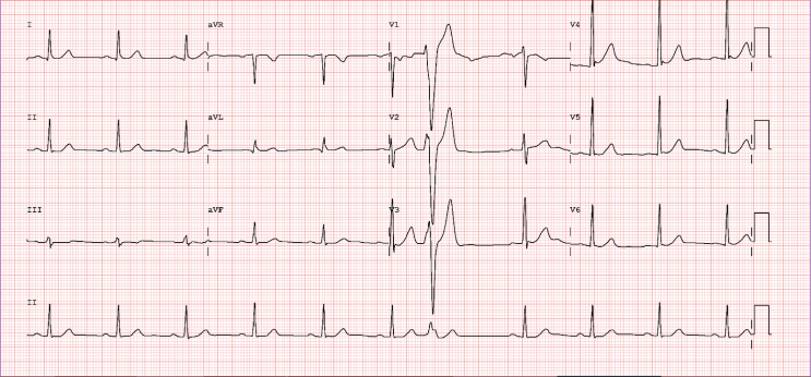두 심전도의 차이는 - WPW의 출현 : 네이버 블로그