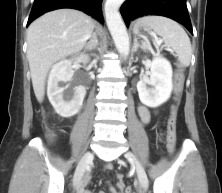 obstructive uropathy due to UPJ stone : 네이버 블로그