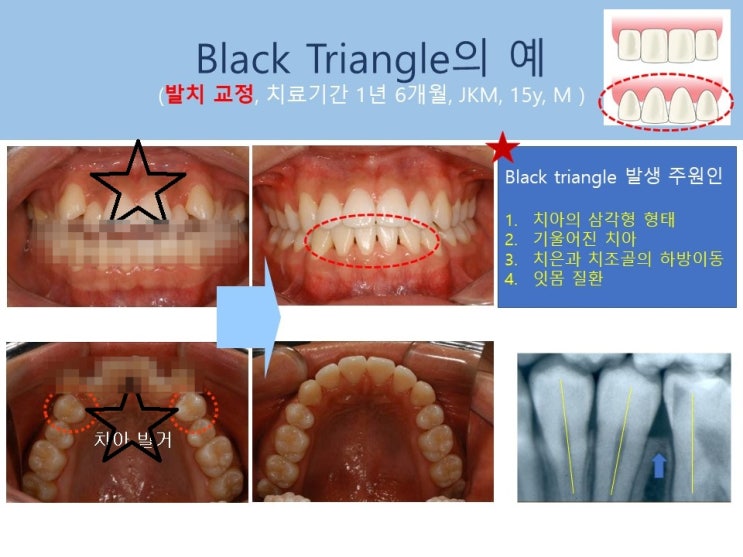 성인이나 교정환자에서 black triangle(치아사이 벌어짐)이 발생하는이유 - 웃는E치과교정과 : 네이버 블로그