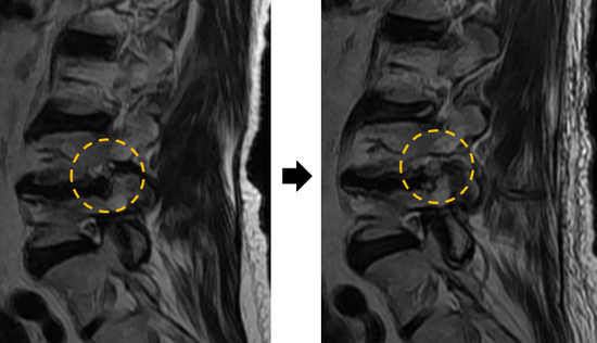 추간공 접근법 - Paraspinal approach L4/5, Lt : 네이버 블로그