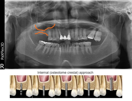 상악동(sinus) 거상술, crestal approach. : 네이버 블로그