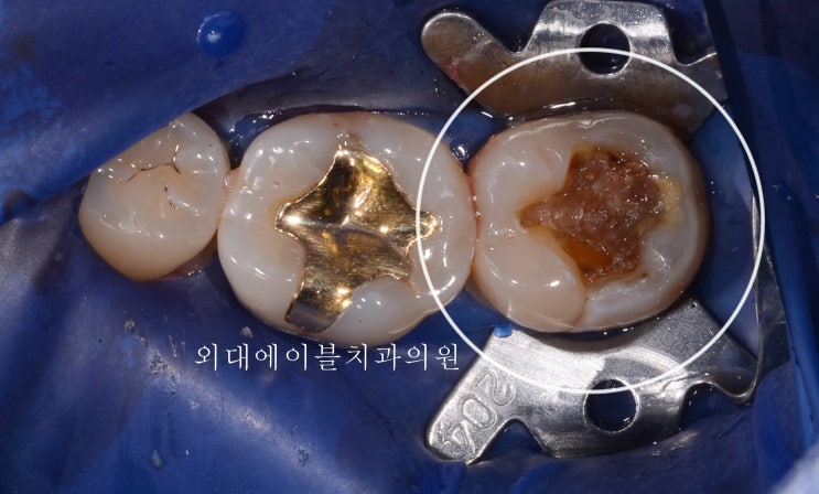 중화역 돌곶이역 치과 이빨 떼운것 떨어진 채로 방치하면 인레이 떨어졌을 때 네이버 블로그