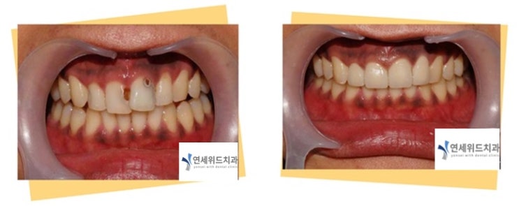 지르코니아 크라운이 진짜 좋은 이유 인천충치치료 인천크라운 연세위드치과 네이버 블로그