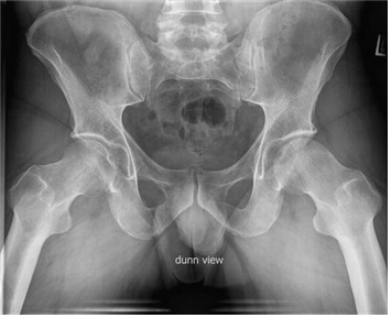 Dunn view : 네이버 블로그