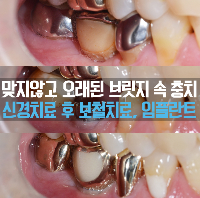 대구치과추천 E28치과 맞지않고 오래된 브릿지 속 충치 제거 신경치료 후 보철치료 임플란트 네이버 블로그