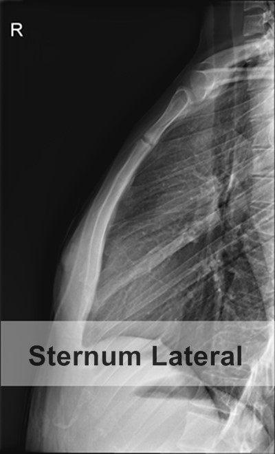 Sternum lateral : 네이버 블로그