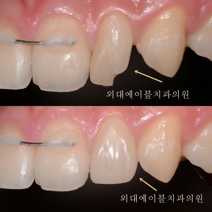 이문동 회기동 치과 이빨 부러졌을 때 치료법 네이버 블로그