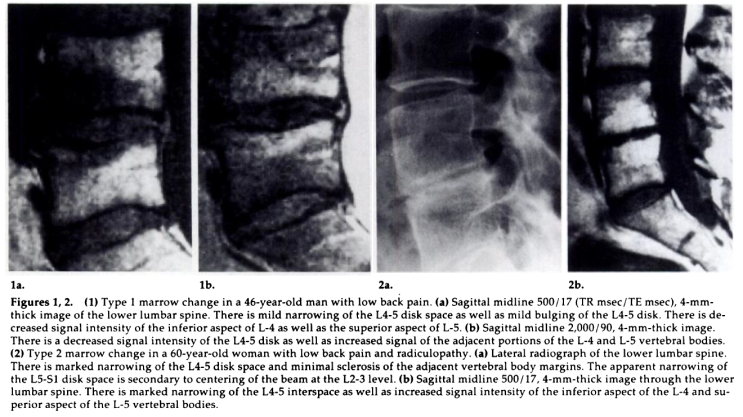 [MRI] Modic changes? : 네이버 블로그