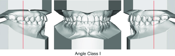 [모형검사] 부정교합의 분류, Angle Classification : 네이버 블로그