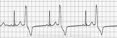 Ventricular Bigeminy : 네이버 블로그