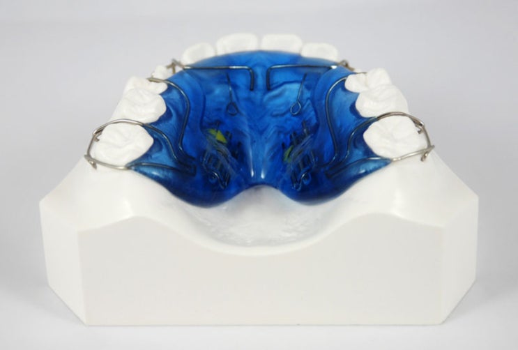 Sagittal Expander: 전후방 악궁 확장 치아교정 장치 : 네이버 블로그