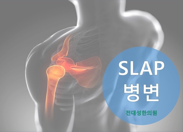 SLAP(Superior Labrum from Anterior to Posterior lesion)- 상부 관절와순 전후방 병변 ...
