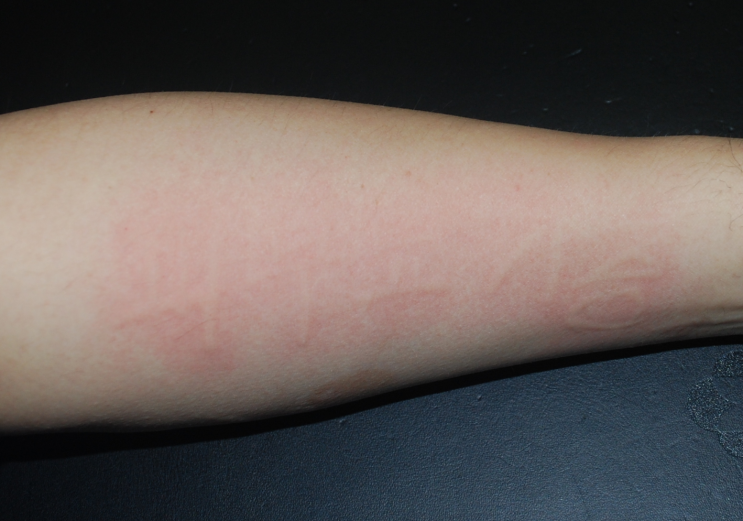 피부묘기증(dermographism) : 네이버 블로그