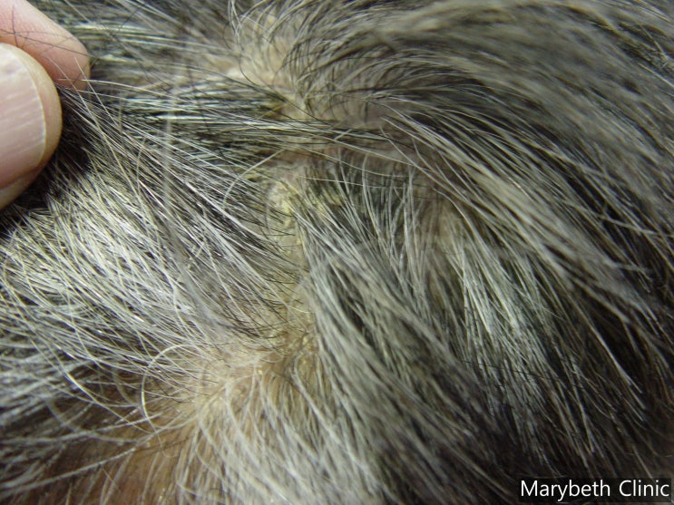 석면모양잔비늘증(Pityriasis amiantacea) : 네이버 블로그