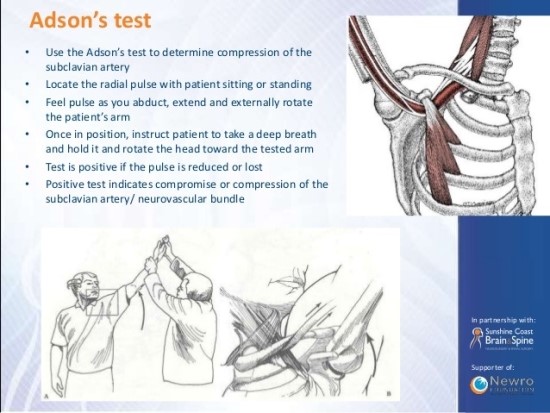 애드손 검사(Adson's test) : 네이버 블로그