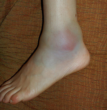 분당 발목 삐끗 접질림 발목염좌 치료 한의원 : 네이버 블로그