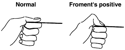 froment's sign - ulnar nerve palsy 검사 : 네이버 블로그