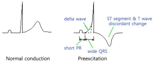 WPW 증후군(조기흥분 증후군) : 네이버 블로그