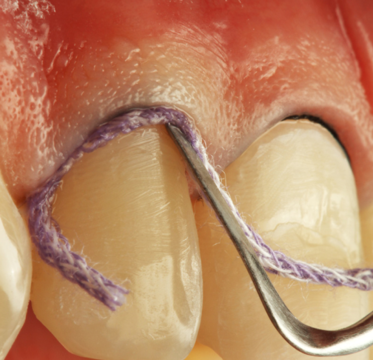 연남동 바른정치과 치과정보)Gingival Cord, 잇몸에 코드넣기 : 네이버 블로그