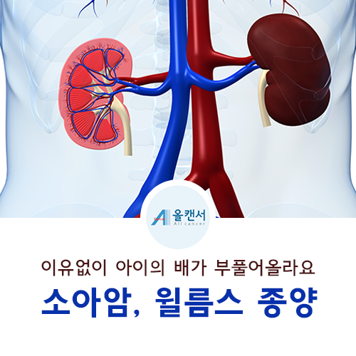 소아암 아이 배가 점점 부풀어 올라요 윌름스종양 신모세포종 네이버 블로그