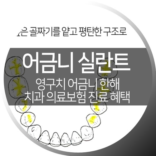 구로치과 초등학생 영구치어금니 실란트 네이버 블로그