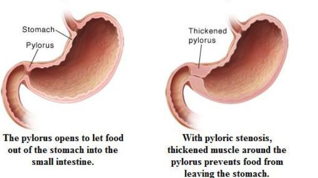 hypertrophic pyloric stenosis : 네이버 블로그