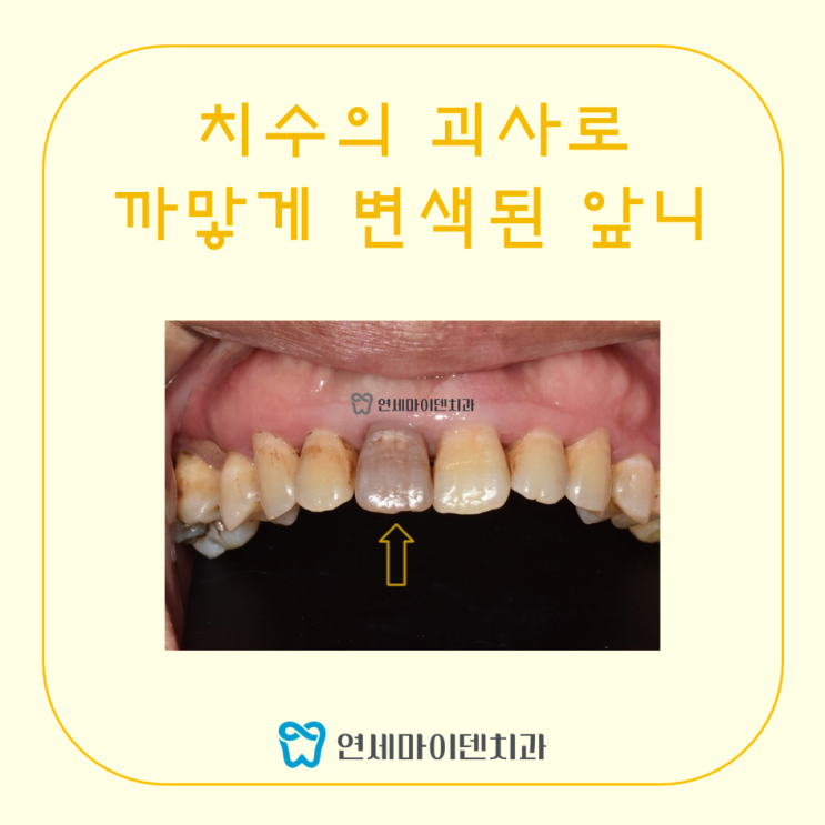 앞니 변색 해결책은 종각치과에서 실활치 미백으로 하얗게 네이버 블로그