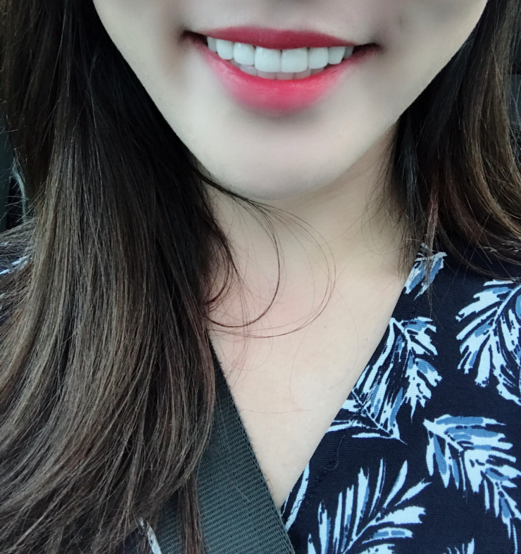 미니쉬? 오늘안 치과에서 직접 내돈주고 한 리얼한 평가! : 네이버 블로그