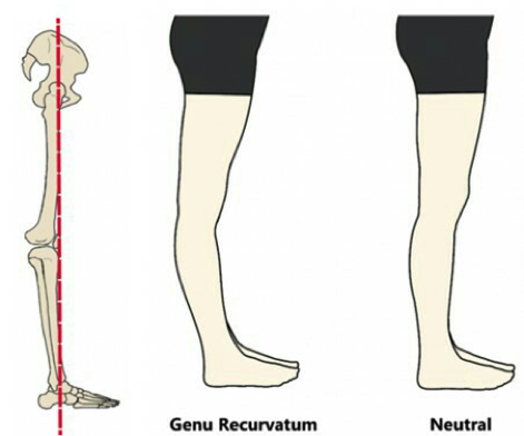 전반슬(genu recurvatum)에 대해 알아보자 : 네이버 블로그