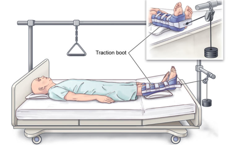 Buck's traction : 네이버 블로그