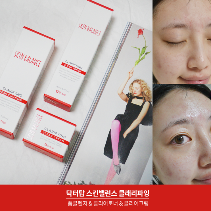여드름화장품추천 닥터탑 스킨밸런스 여드름 폼클렌저 스킨 크림 네이버 블로그