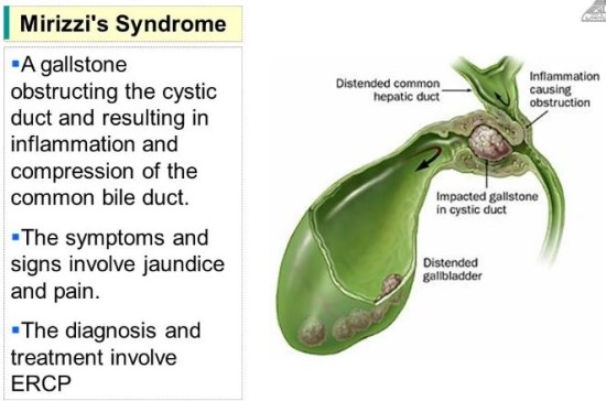 [Liver] Mirizzi syndrome (미리찌 증후군) : 네이버 블로그