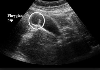 [GB] phrygian cap, adenomyomatosis : 네이버 블로그