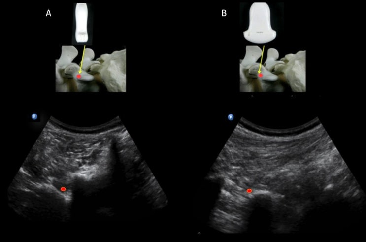 [초음파] 요추부 초음파 중재술(3) Lumbar medial branch (L1-L4) & facet block (L1-L4 ...