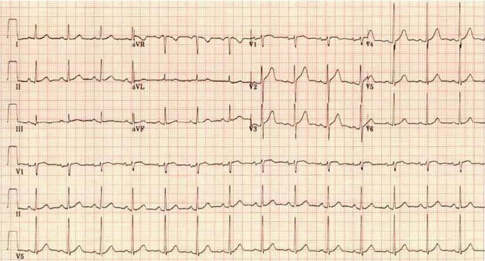 이형협심증(변이협심증, Prinzmetal's variant angina) : 네이버 블로그