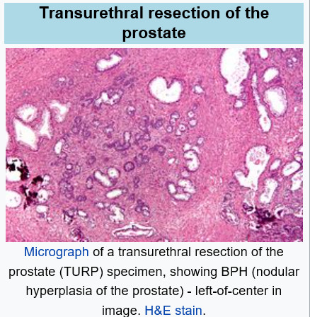 transurethral resection of prostate (TURP) : 네이버 블로그
