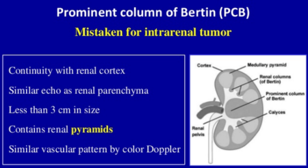[Kidney] Prominent coulmn of Bertin, Dromedary Hump : 네이버 블로그