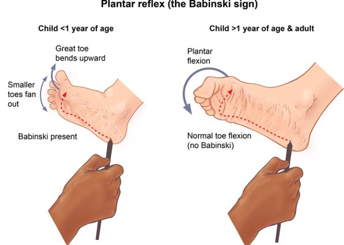 [NCLEX 미국간호사 면허 독학 pediatric] 바빈스키 반사(Barbinski sign) 1살 infant Plantar ...