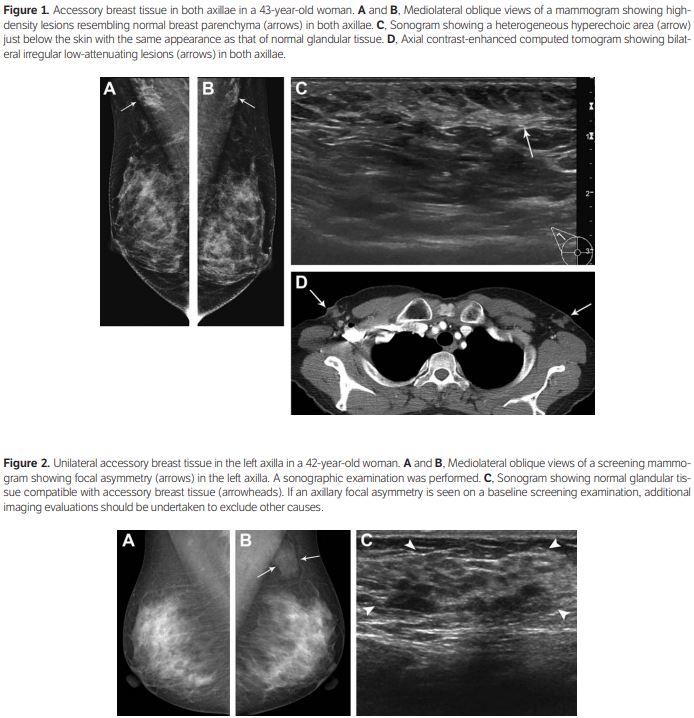 [Breast] Accessory Breast tissue : 네이버 블로그