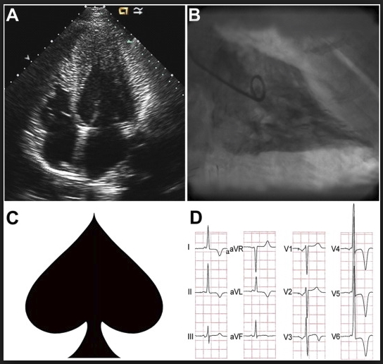 Apical hypertrophic cardiomyopath(HCM) : 네이버 블로그