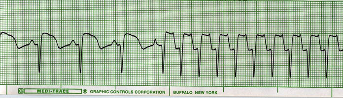 PSVT(paroxysmal supraventricular tachycardia) 발작성 상심실성 빈맥 : 네이버 블로그