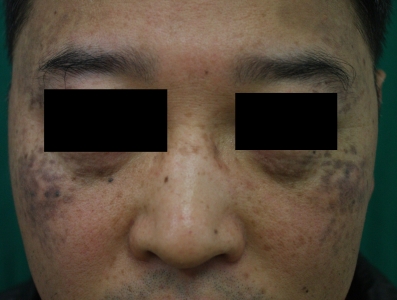 후천성오타모반 (애브넘,ABNOM) (피부과전문의) : 네이버 블로그