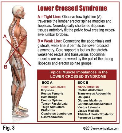 하지교차증후군Lower Cross Syndrome(운동에 빠지다) : 네이버 블로그