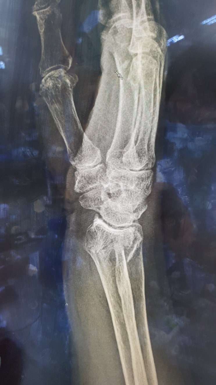 closed reduction of Colles fracture : 네이버 블로그