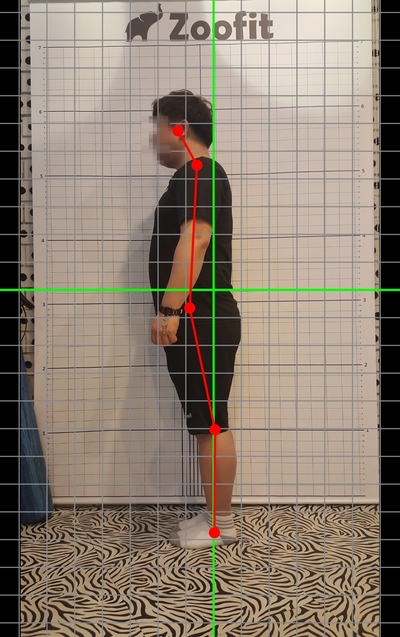 Extension rotation syndrome 과 flat foot의 관계 : 네이버 블로그