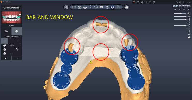 [Dentiq Guide] Digital Surgical Guide Implant planning : 네이버 블로그