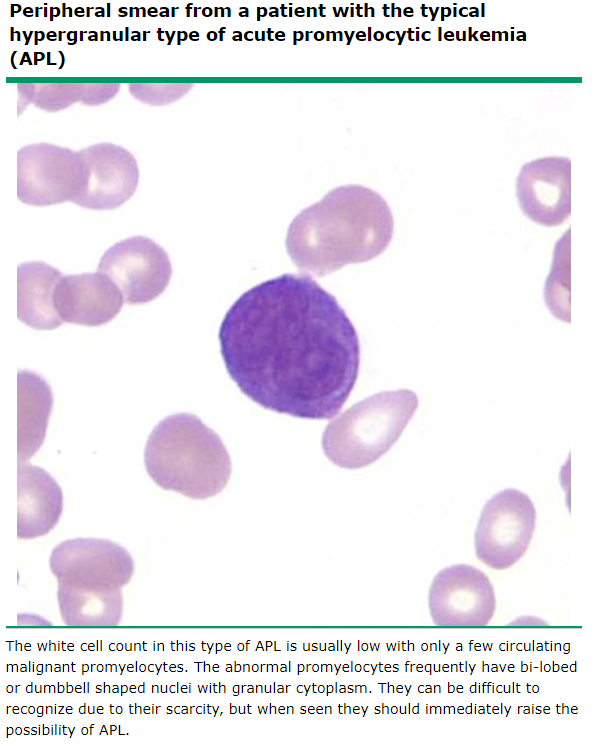 급성 전골수성 백혈병, 형태, Acute promyelocytic leukemia(APL), morphology : 네이버 블로그